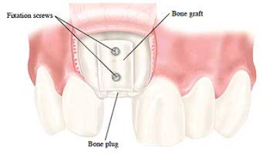 Bone Grafts, Sinus Lifts - Oceansight Dental & Implants